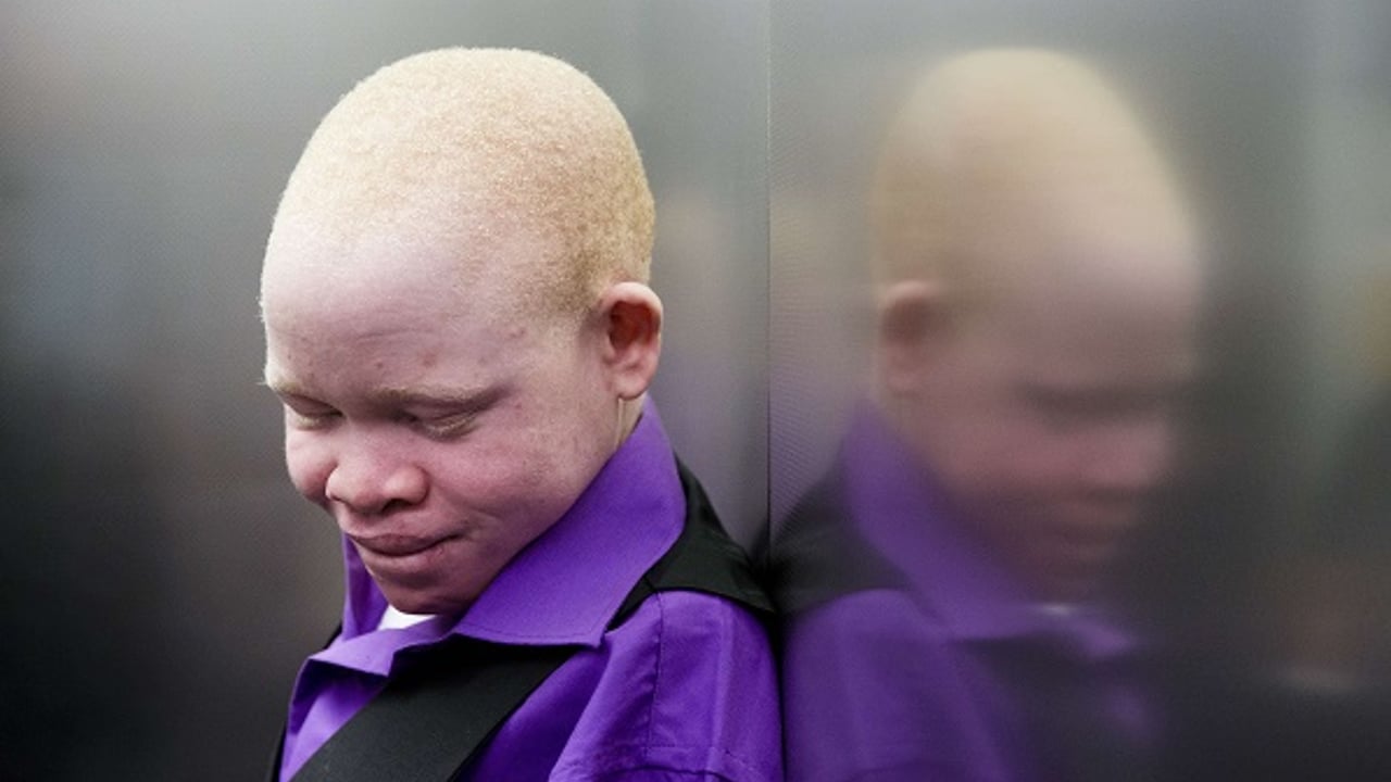 RDC : Djino Kaporedji et Paul Le Perc s’engagent aux côtés des albinos