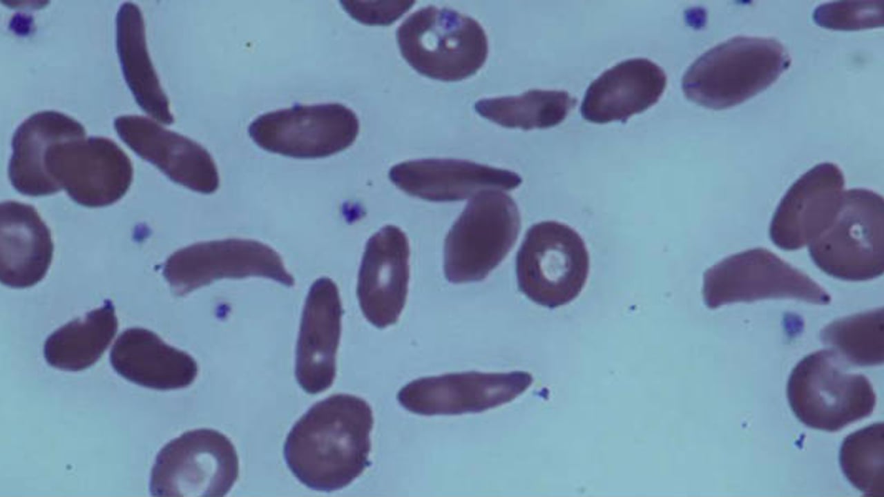 Drépanocytose : la thérapie génique offre de nouveaux espoirs pour les ...